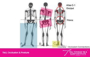 Connection Between TMJ and Body Posture - TMJ, Tongue Tie & Sleep ...